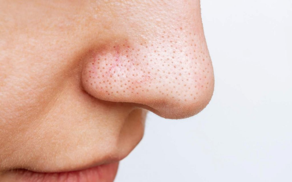 Duo Guide: Understanding Large Pores and How to Refine Them – DuoGen Canada